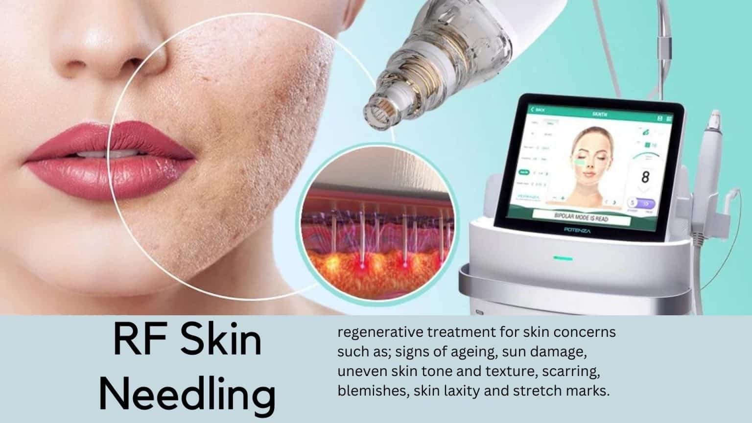 RF Micro Needling - Cosmoderma